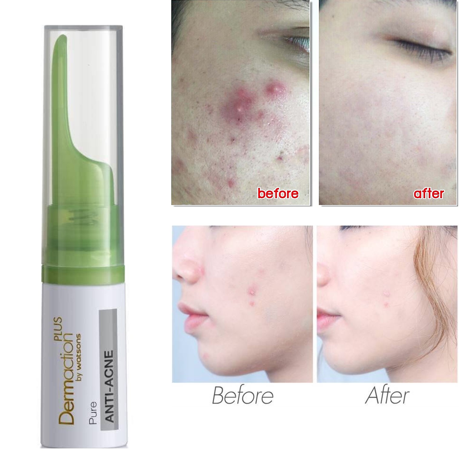 Dermaction Plus by Watsons Pure Anti-Acne Overnight SOS Sport Corrector ...