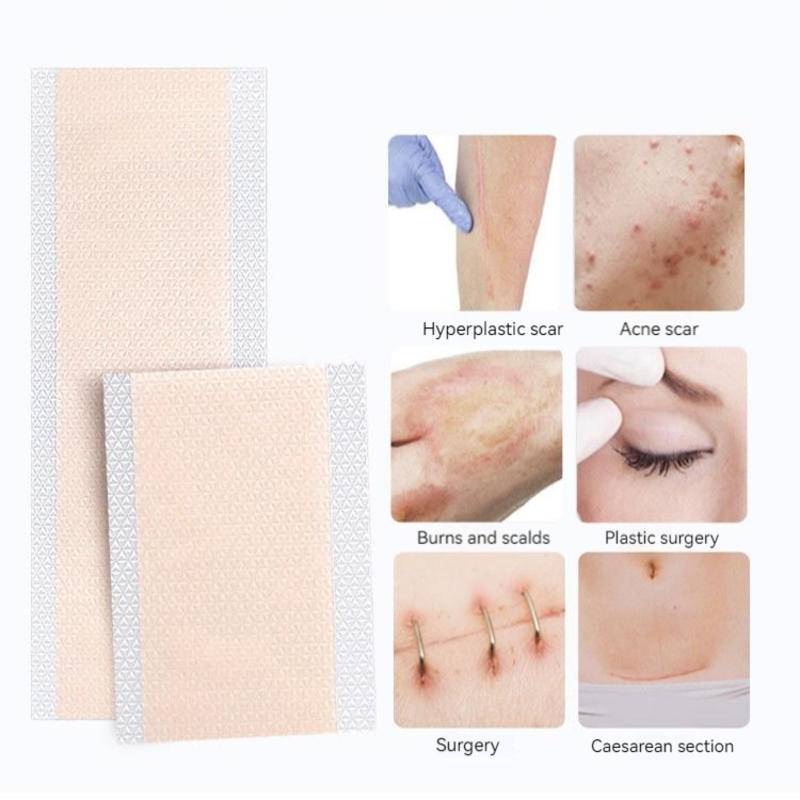 5pcs Silicone Removal Patch Waterproof Acne Gel Scar Therapy Section ...