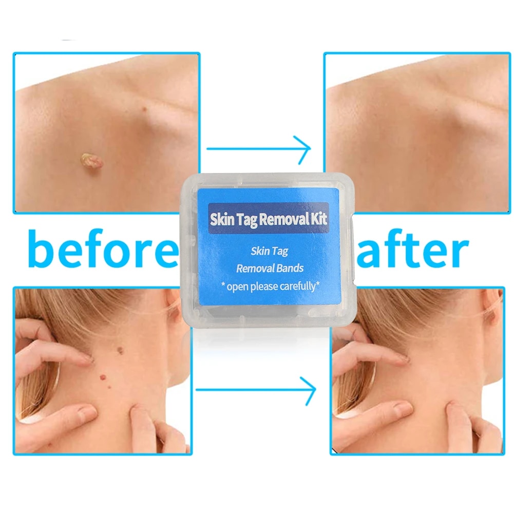 BeliefMelief Profesional 30pcs/box Mole Removal Rubber Bands Kit Non ...
