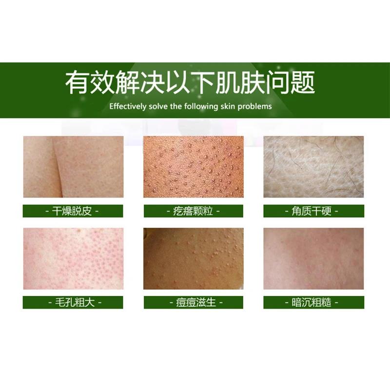 Malic Acid Treatment Body Ichthyosis Leg Keratosis Follicularis Cream ...