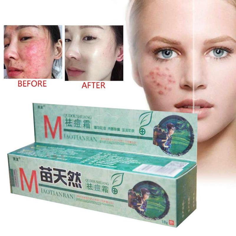 【0ddf02d4】Natural Germicidal Removal Cream Mite Moisturize Skin Cream ...