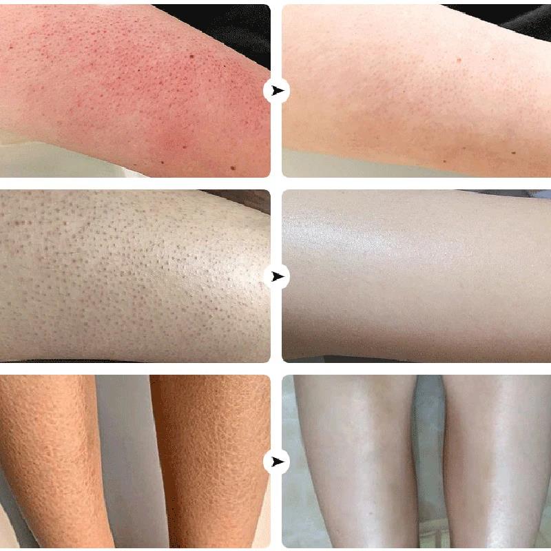 New Chicken Skin Repair Cream Curing Keratosis Follicle Pilaris Remove ...