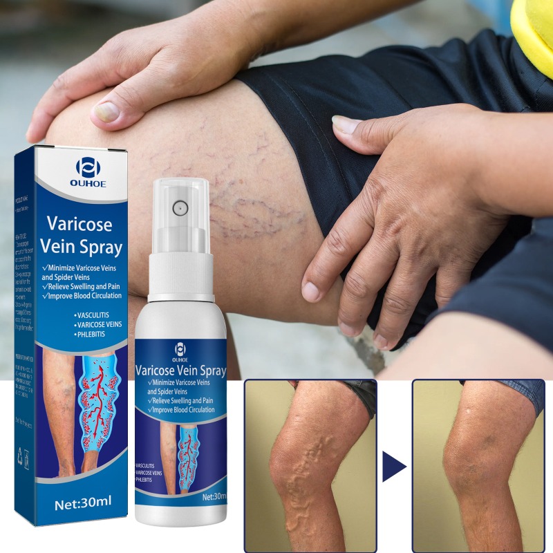 Aweisuan Hot Sale Varicose Vein Spray Treatment Phlebitis Vasculitis ...