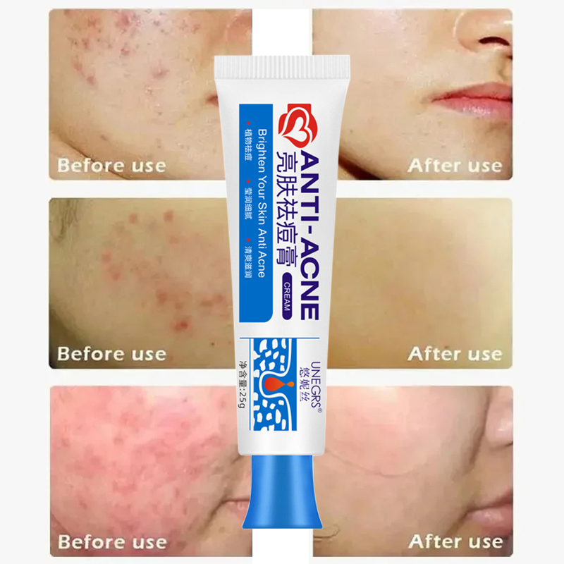 Anti-acne Treatment Cream Salicylic Acid Acne Deep Cleaning Pore Repair ...
