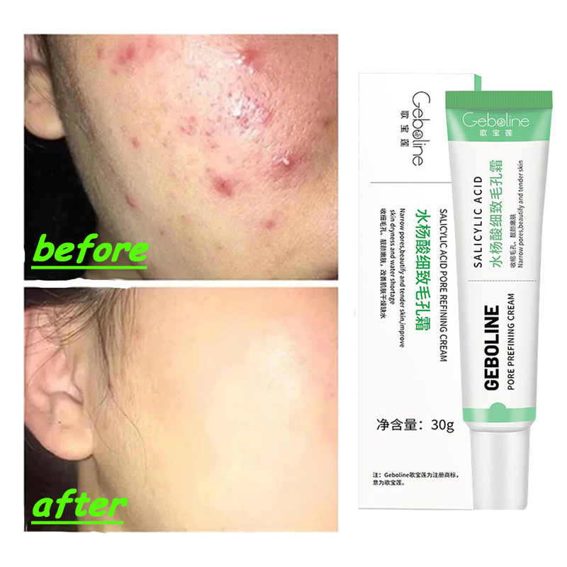 Salicylic Acid Pore Shrinking Cream Quick Elimination Large Pores ...