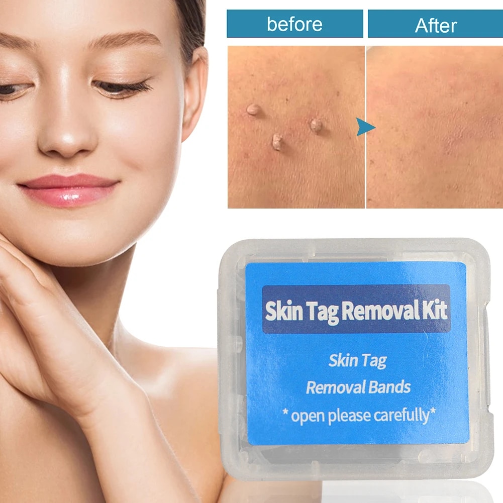 BeliefMelief Profesional 30pcs/box Mole Removal Rubber Bands Kit Non ...