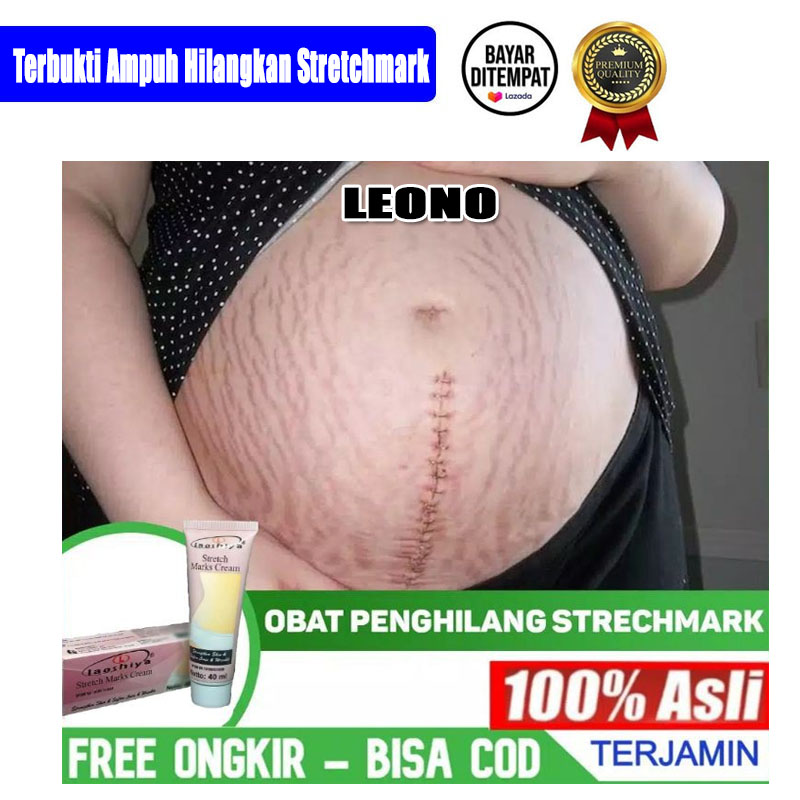 Penghilang Strechmark Ibu Hamil Penghilang Selulit Operasi Cream ...
