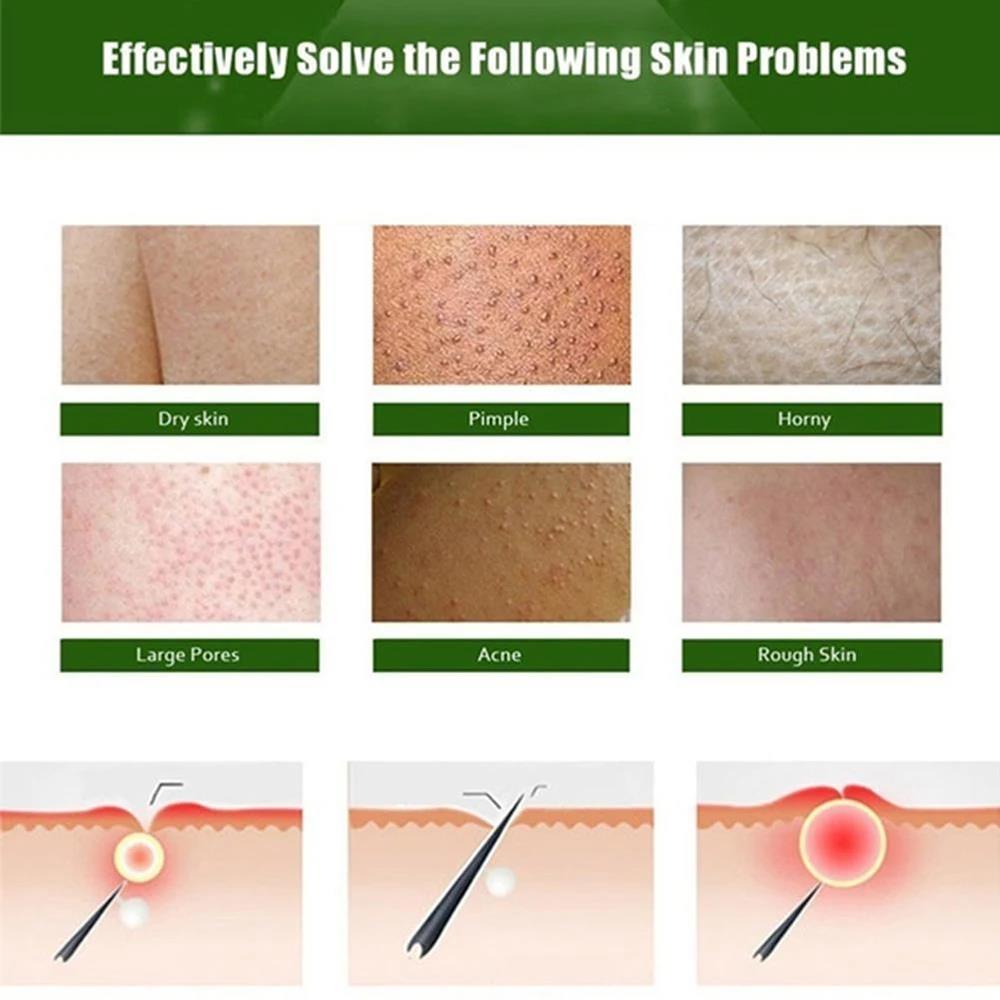 New Chicken Skin Repair Cream Curing Keratosis Follicle Pilaris Remove ...