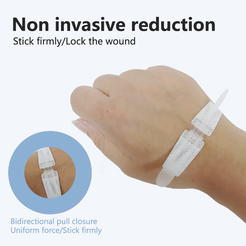 Zip Stitch Wound Bandages Emergency Wound Closures Adhesive Seamless ...