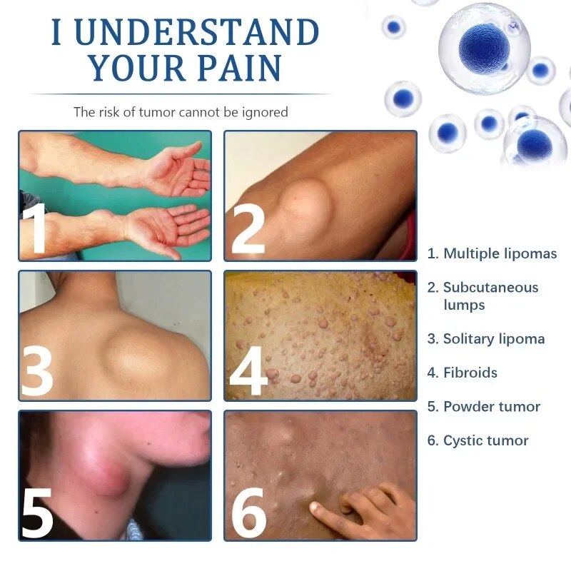 Lipoma Removal Patch Remove Fat Lump Nodular Sticker Anti-Tumor ...