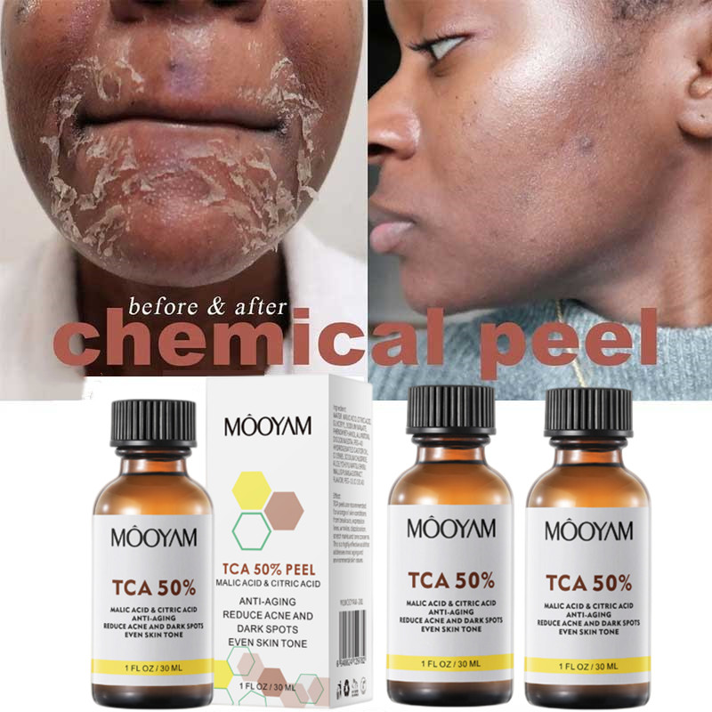【Customizable】 Tca 50% Chemical Peel Tca Peel Acid Skin Superforce Peel ...