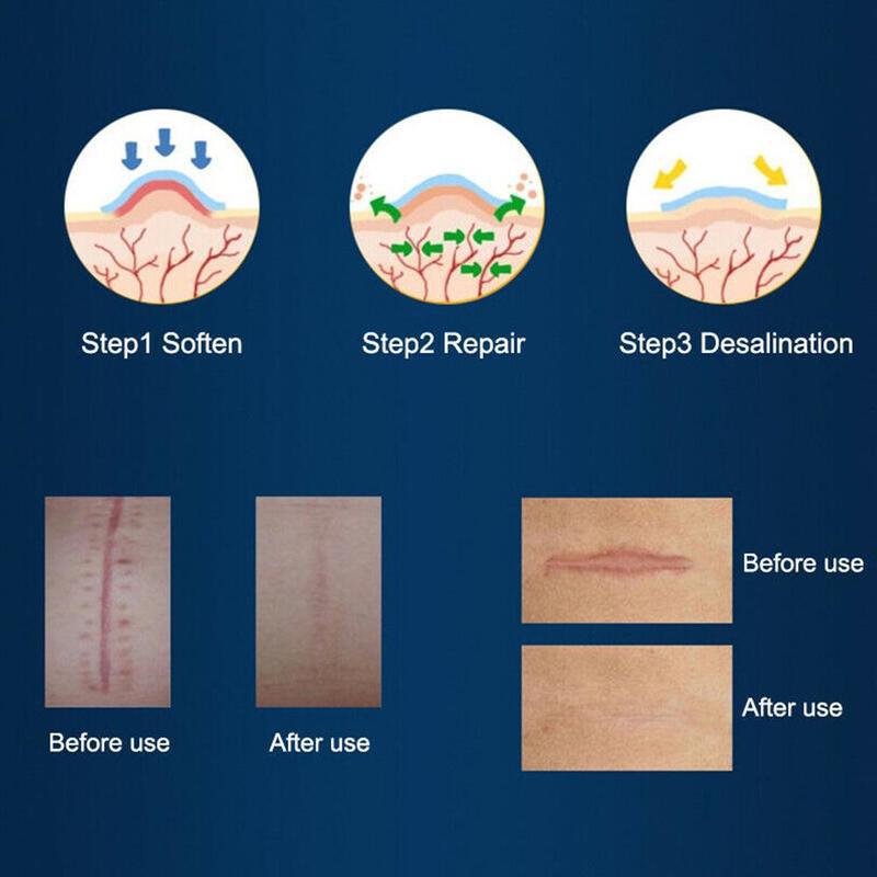 【TrendGlobe】Silicone Gel Sheet Wound Marks Removal Cesarean Medical ...