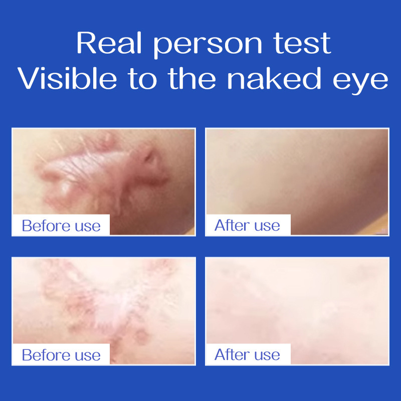 EBiSU VC underarm Whitening Cream Light Black Whitening and White Lean ...