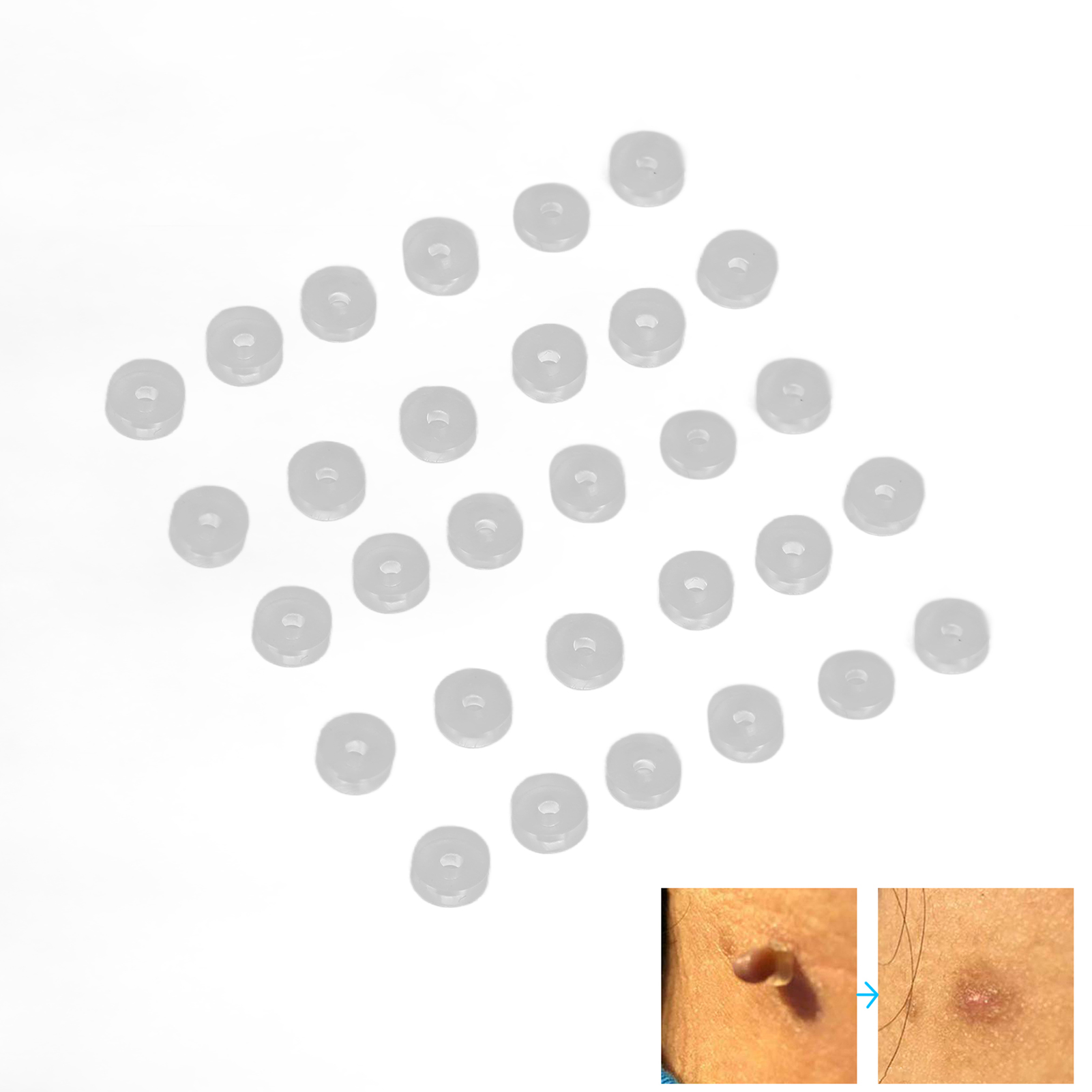 30pcs Face Care Skin Tag Rubber Bands Beauty Health Mole Wart Removal ...