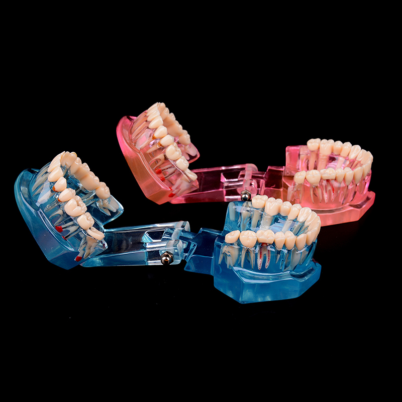 【High-quality】Dental Implant Disease Teeth Model For Medical Teaching ...