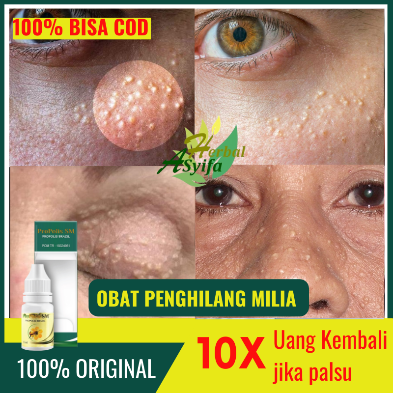 Obat Penghilang Milia di Wajah, Bintik Milia di Hidung, Milia di Mata ...