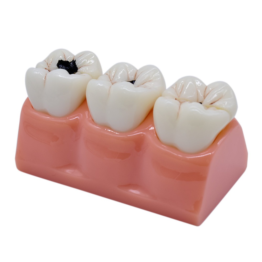 Dental Model Four Times Caries Evolution Model Tooth Decay ...