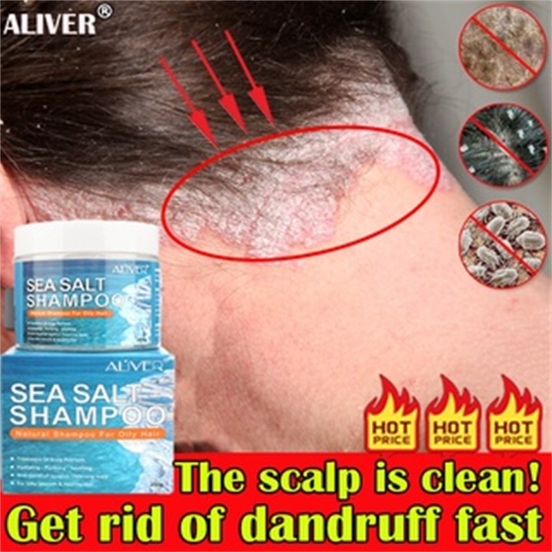 Quickly remove dandruff. ALIVER sea salt shampoo dandruff lice remover ...