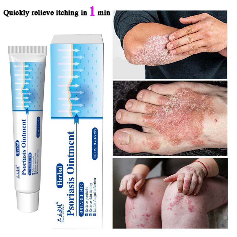 100% Effective Herbal Psoriasis Dermatitis Eczema Pruritu Psoriasis ...