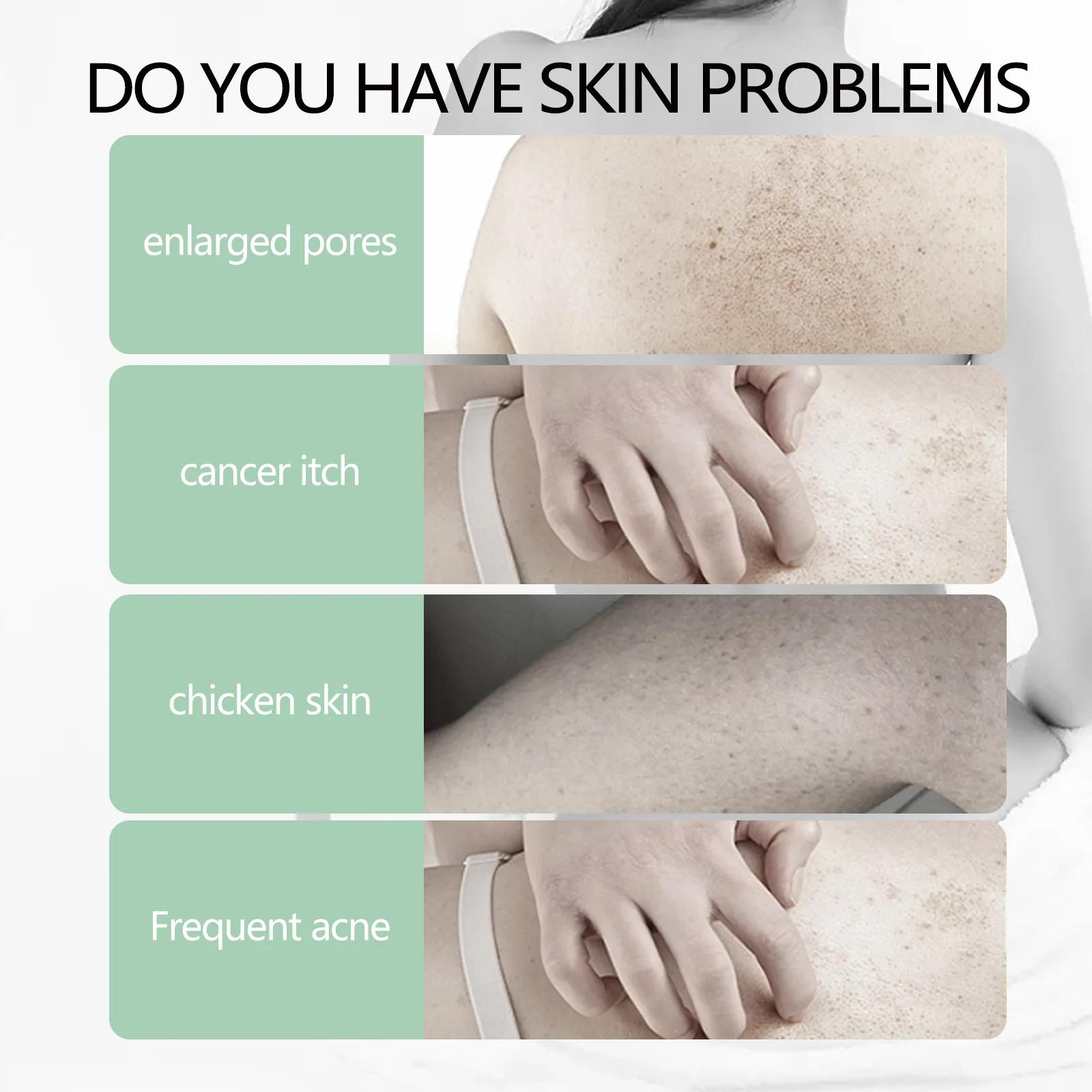 Keratosis Pilaris Repair Cream Cleaning Acne Spots Remove Follicle ...