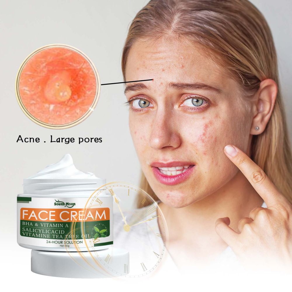 Acne Remover Cream Pimple Marks Remover Cream Acne Treatment 30g Lazada Ph