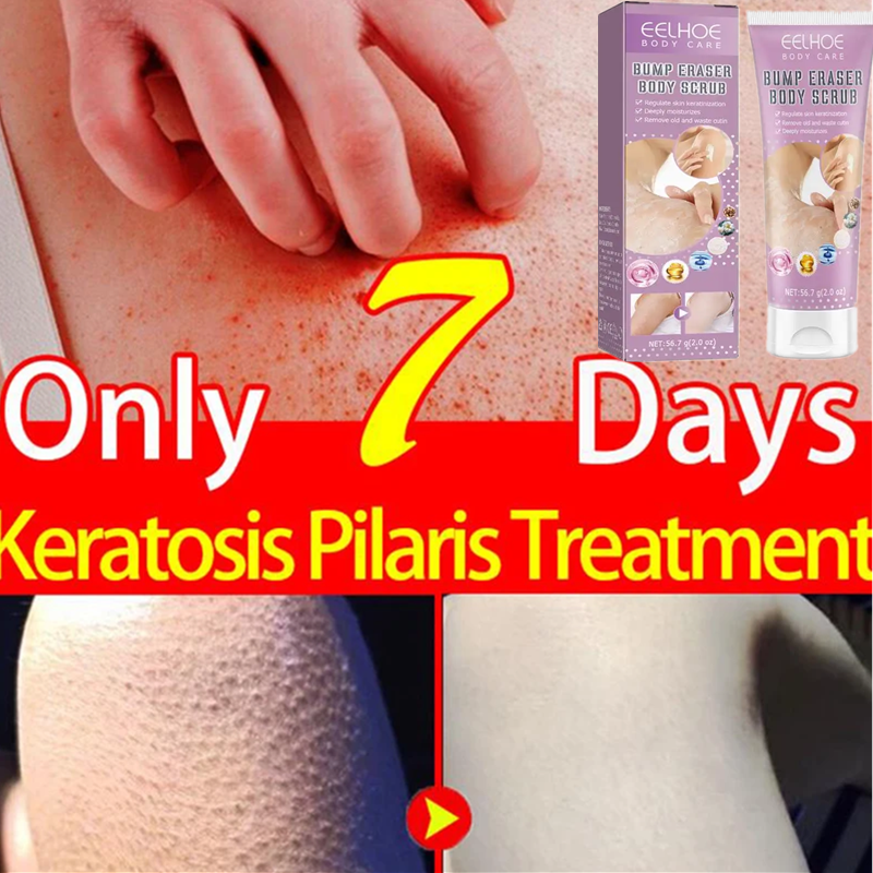 Keratosis Pilaris Cream Nourishing Moisturizing For Strawberry Legs ...
