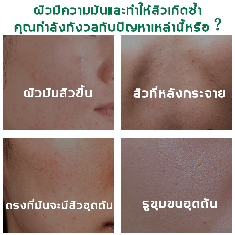 สบู่กำจัดสิว ZILIN สบู่ลดสิวหน้า 100g (สบู่ล้างหน้าใส สบู่ลดรอยสิว สบู่ ...