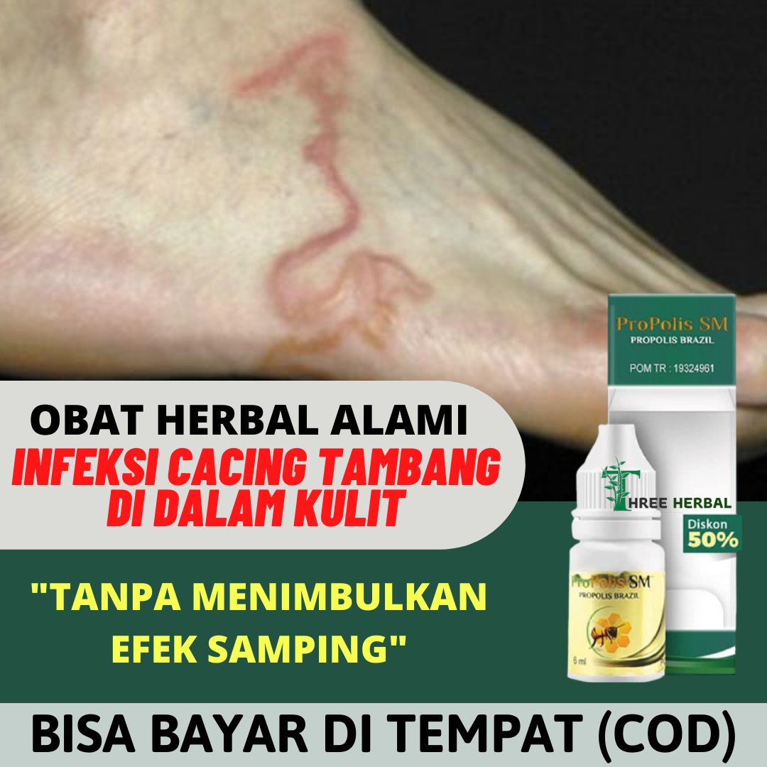 Obat Herbal Infeksi Cacing Tambang - Obat Cacing Kecil Di Dalam Kulit ...