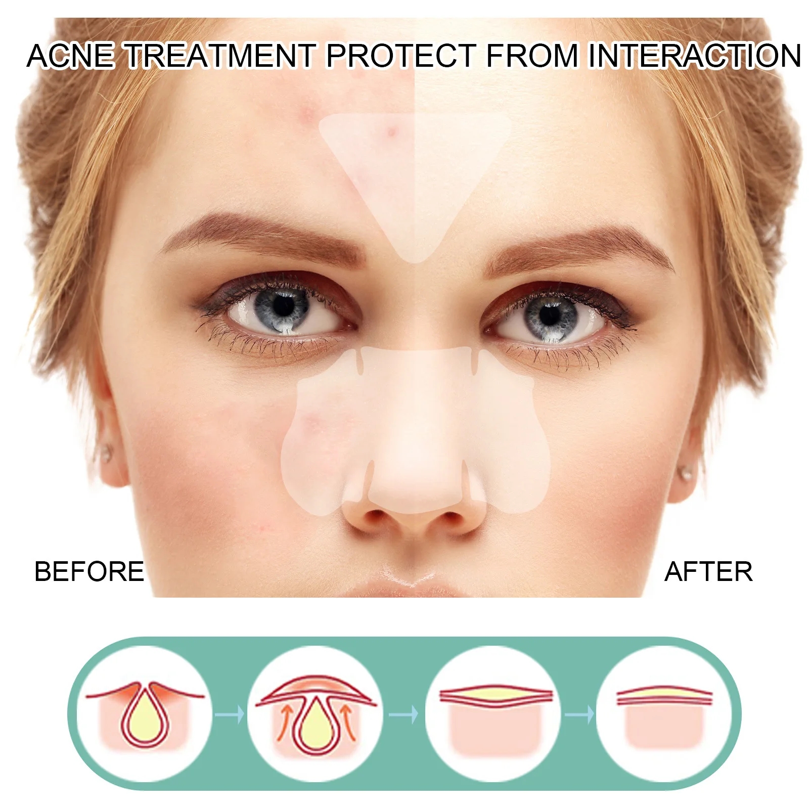 Yuanyan 132Pcs Acne Pimple Patches Stickers Acne Spot Invisible ...