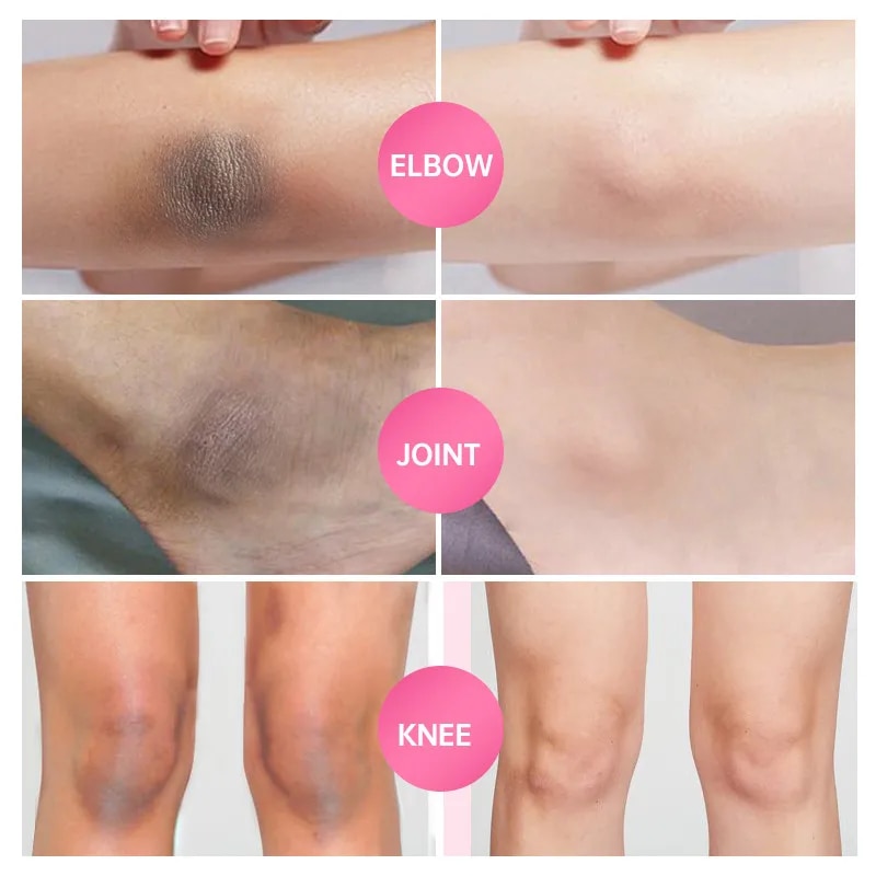 Body Whitening Cream Bleach Intimate Areas Armpit Knee Private Parts ...