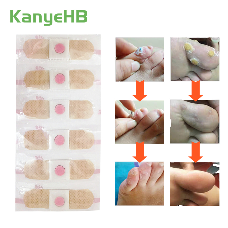 【TrendGlobe】48pcs Detox Foot Corn Remover Patch Removal Foot Pads Warts ...