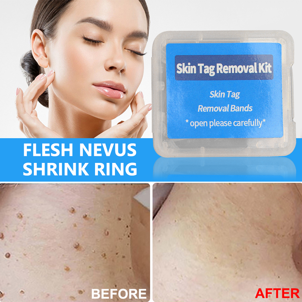 30pcs/box Flesh Nevus Removal Bands Non-Toxic Mole Removal Rubber Bands ...