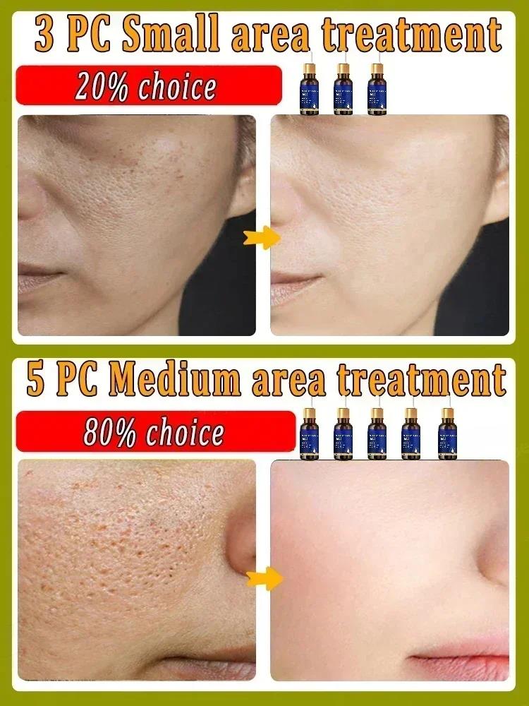 【sought-after】 Removing Large Pores Pore Shrinking Serum Tightening ...