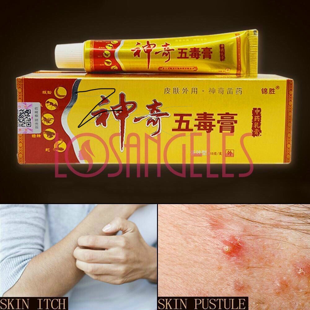 Combo 25 tuýp kem bôi Kem Bôi Da Liễu Vẩy nến, á sừng, hắc lào, lang ...