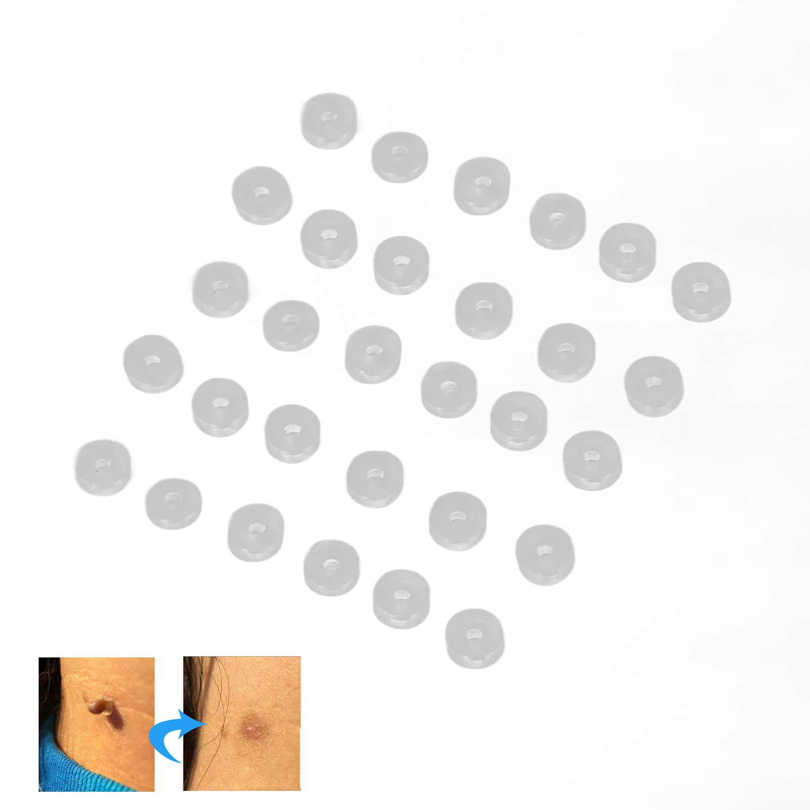 30pcs Face Care Skin Tag Rubber Bands Beauty Health Mole Wart Removal ...