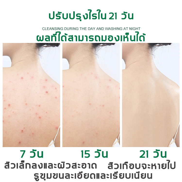 สบู่กำจัดสิว ZILIN สบู่ลดสิวหน้า 100g (สบู่ล้างหน้าใส สบู่ลดรอยสิว สบู่ ...