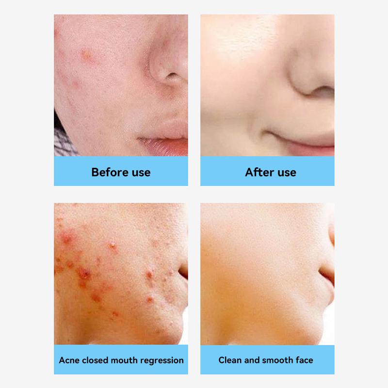 Anti-acne Treatment Cream Salicylic Acid Acne Deep Cleaning Pore Repair ...