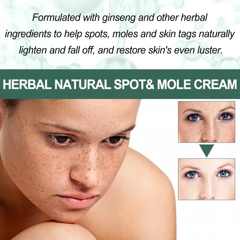 Anti freckle cream fade spots pimple improve dull Melanin remove Acne ...
