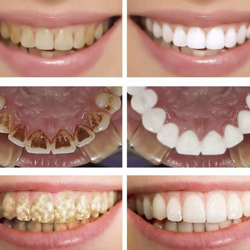 Smokers Teeth Bright Tooth Cleaning Liquid | Daraz.lk