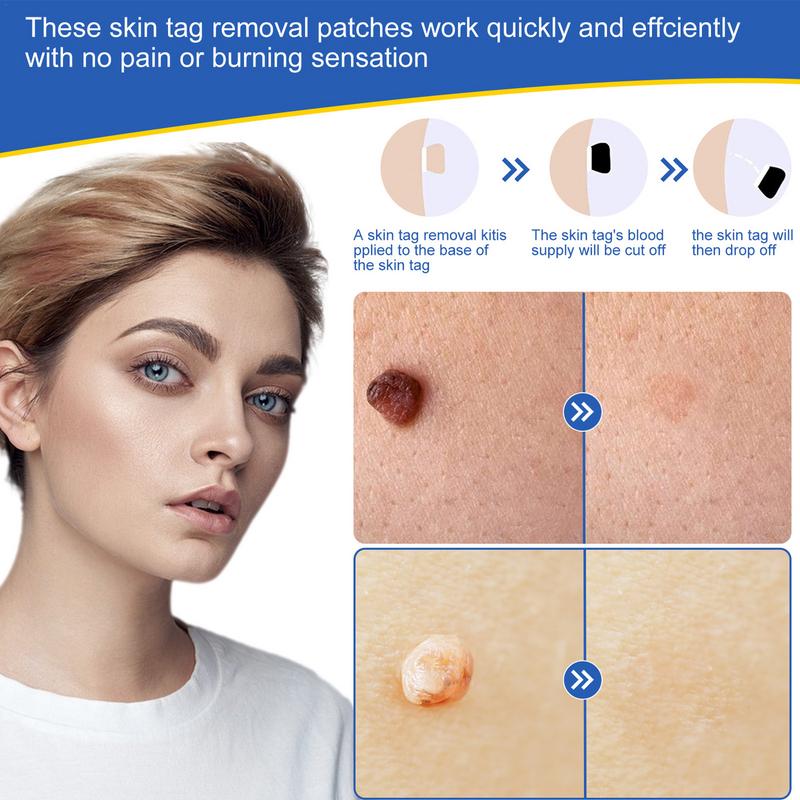 Remove Skin Tags Skin Tags Removal Tool With Two Cones 2mm 9mm Wart ...