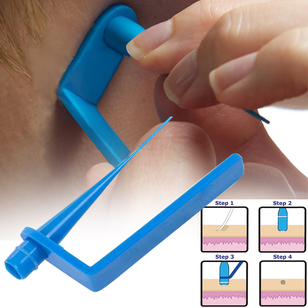 Papilloma Removal Tool For Small To Medium Face Care Blue Micro Band ...