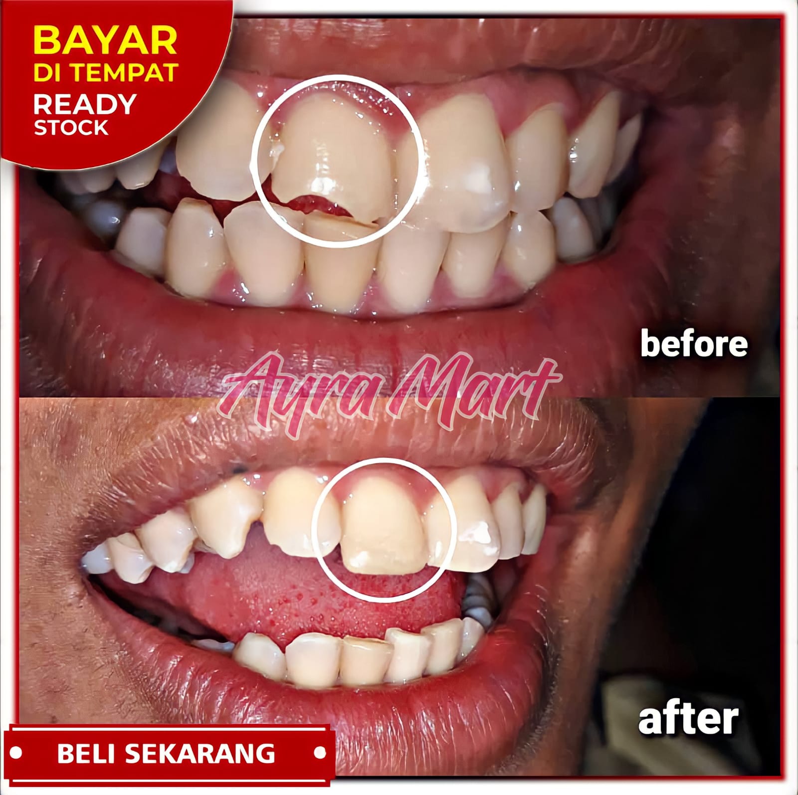 GIGI PASLU PERMANEN KUAT ORI Penutup gigi rusak Tambal gigi ompong ...
