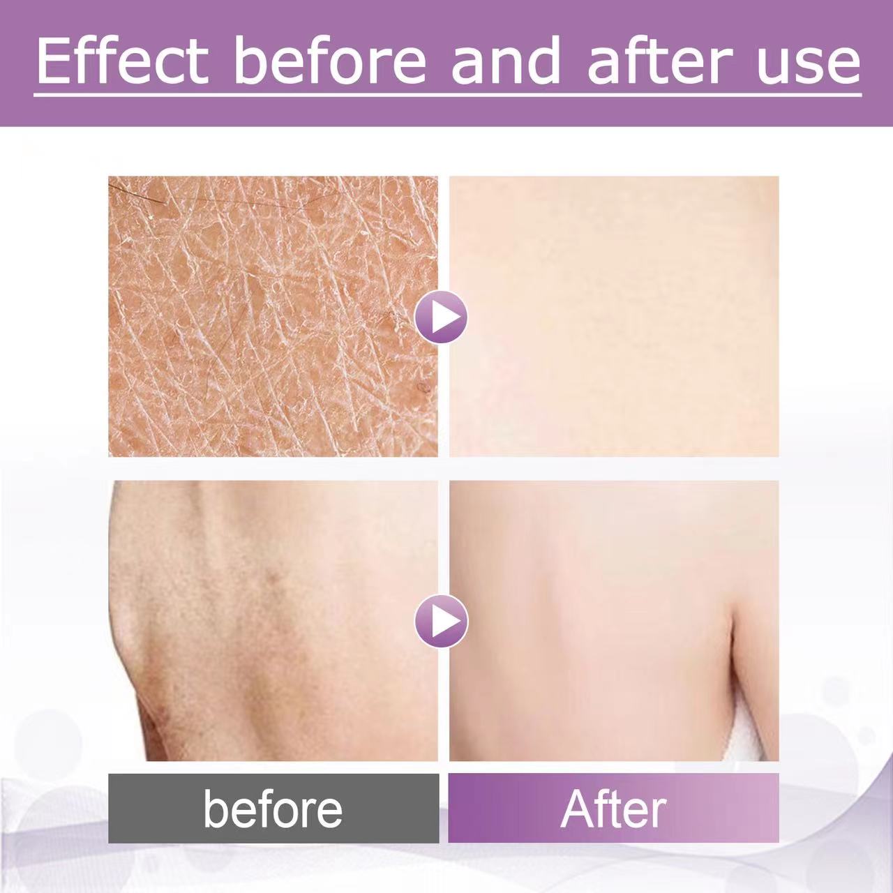 Keratosis Pilaris Cream For Strawberry Legs Removal KP Bump Eraser Body ...