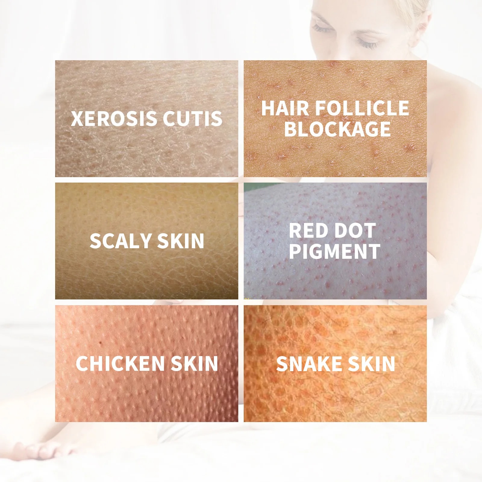 Keratosis Pilaris Removal Cream Chicken Skin Folliculities Treatment ...