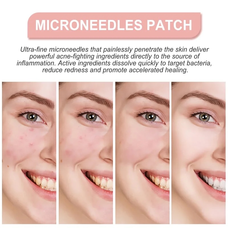 72/180Pcs Invisible Acne Pimple Patch Sticker Pimple Remover Tool ...