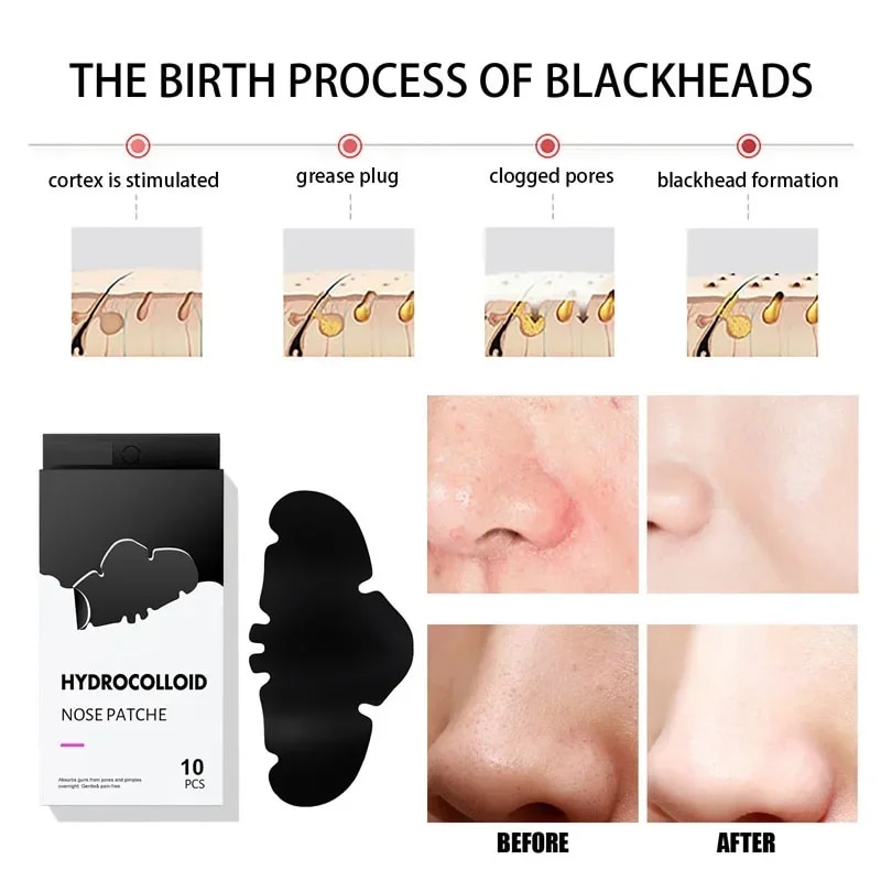 10pcs Nose Blackhead Remover Shrink Pore Acne Treatment Black dots Pore ...