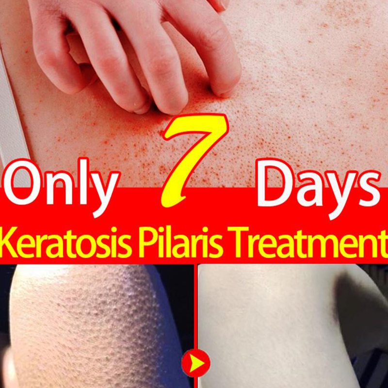 Keratosis Pilaris Cream For Strawberry Legs Removal KP Bump Eraser Body ...