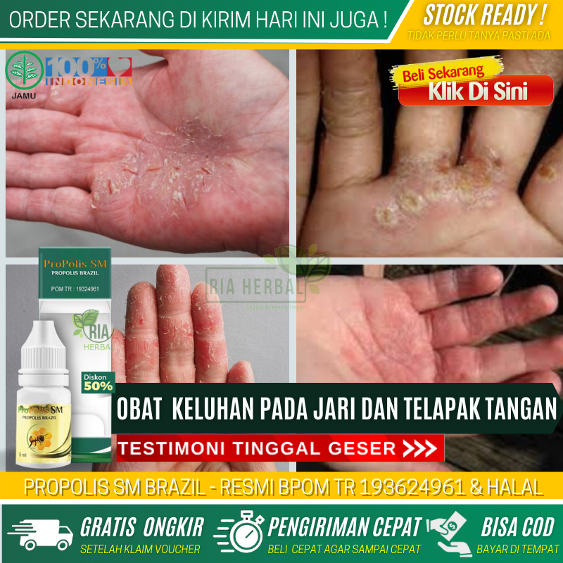 Obat Gatal Kuman Air Untuk Anak, Obat Tetes Kutu Air Di Tangan Yang ...