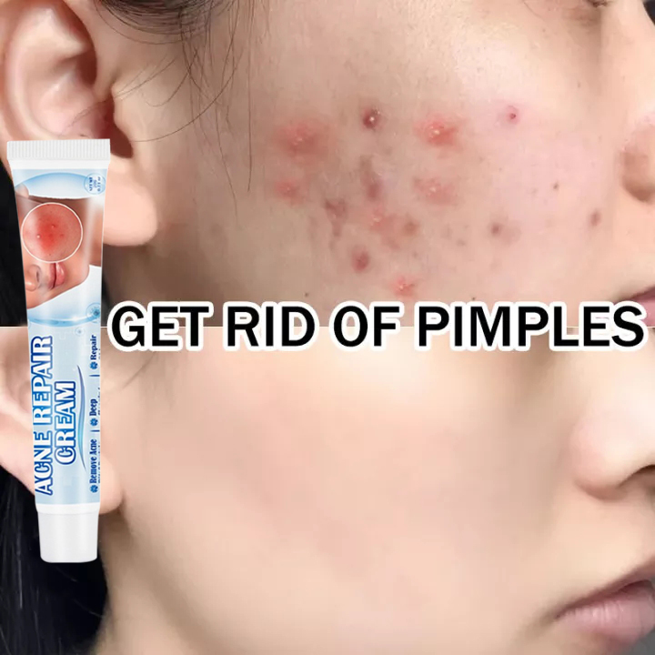 [BEST SELLER] 20g Remove Pimples Quickly Pimple Remover Acne Cream Fades Acne Marks Repairs Acne ...
