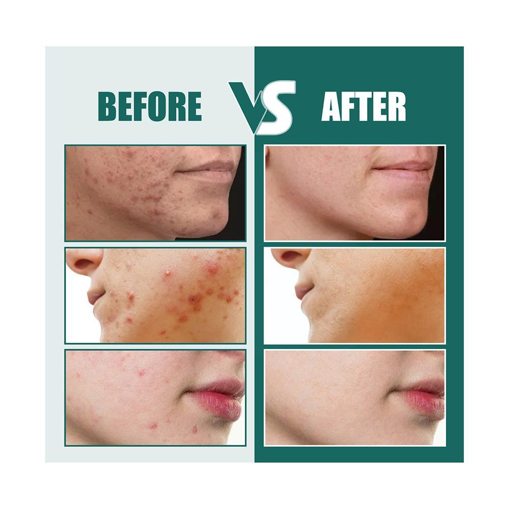 New Star Pimple Patch Stickers Dazzling Colorful Face Acne Removal Skin ...